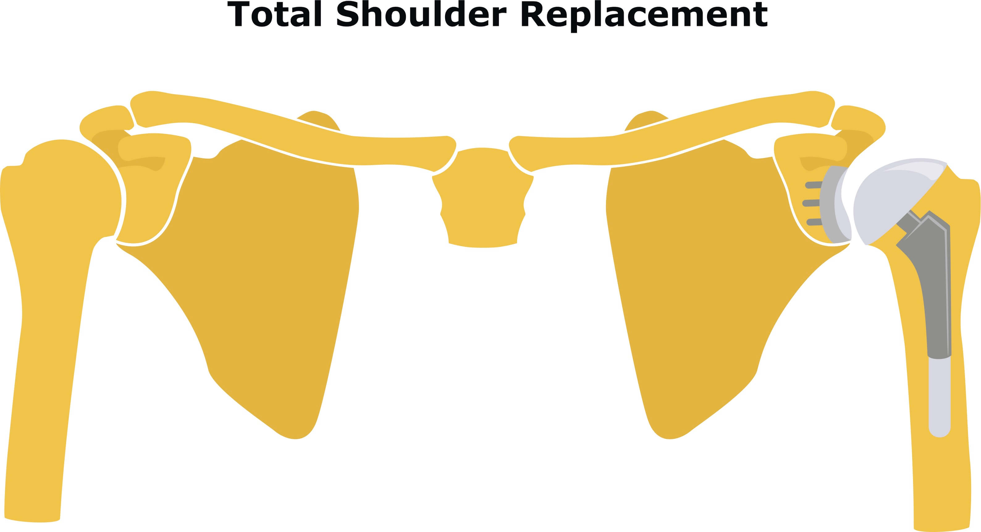 Should I Get a Total Shoulder Replacement? Considerations and How ...